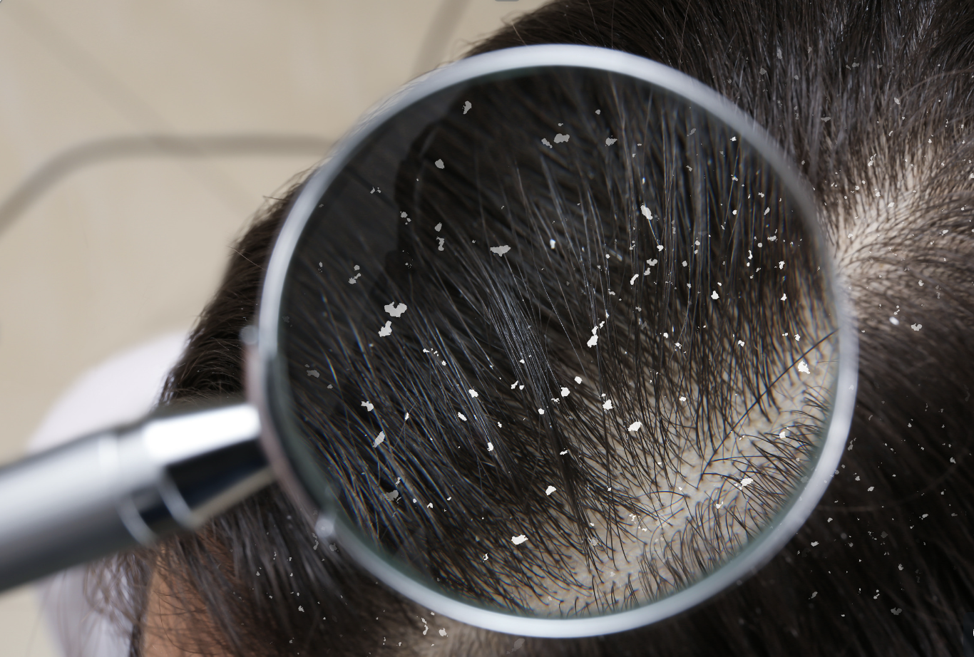 Causes of an Itchy Scalp - Is It Head Lice? - Chicago Lice Removal Is ...